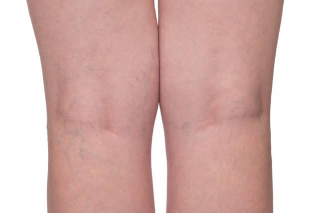 Reticular Veins: Causes and How to Treat Them | Advanced Skin Therapy ...